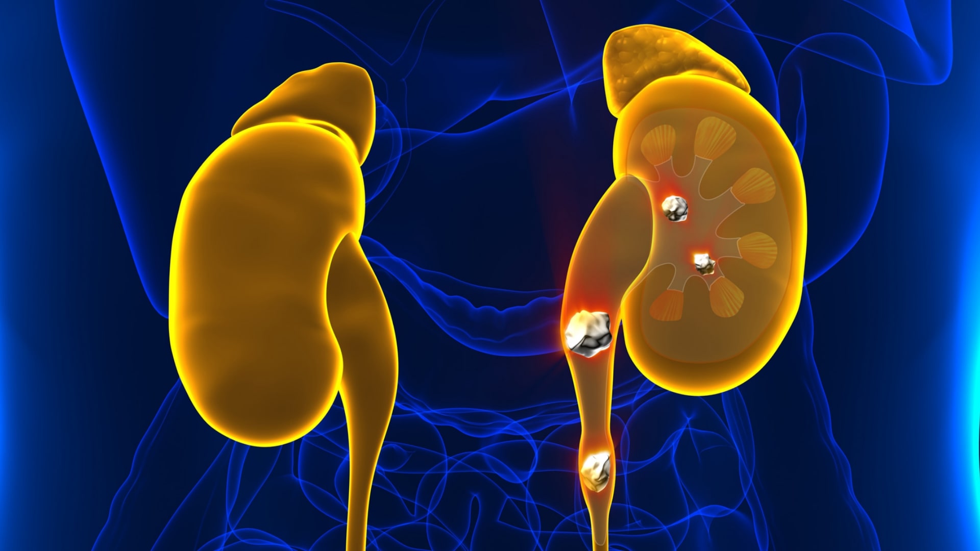 Calcul Urinaire Paris | Prise en charge urologique | Urologue | UCP